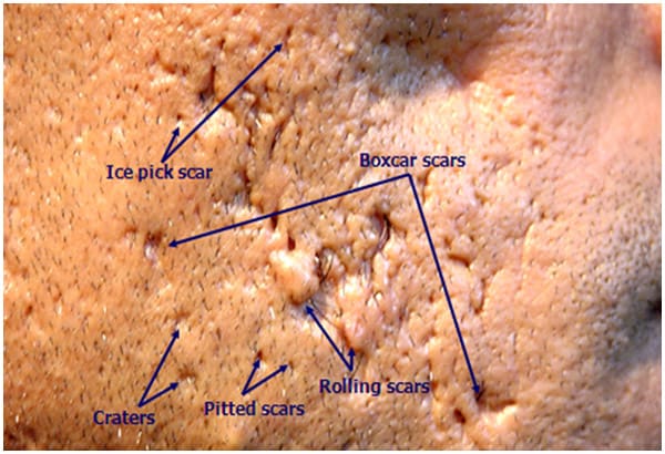 Clinica Wulkan – Tipos de cicatriz de acne e tratamento de cicatriz de acne